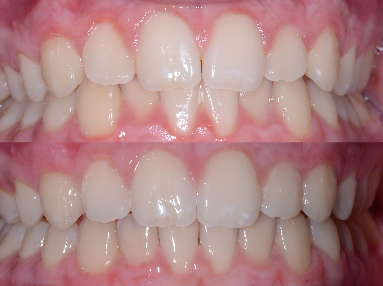 What You Need To Know About Gaps Between Teeth